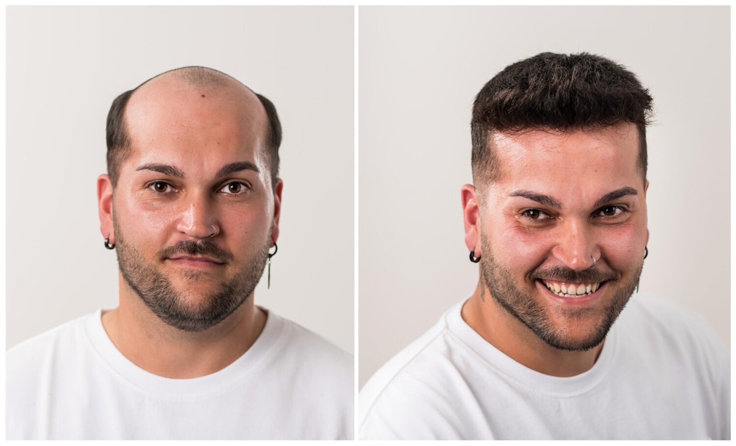Descubre las prótesis capilares para hombres: la solución a la alopecia ...